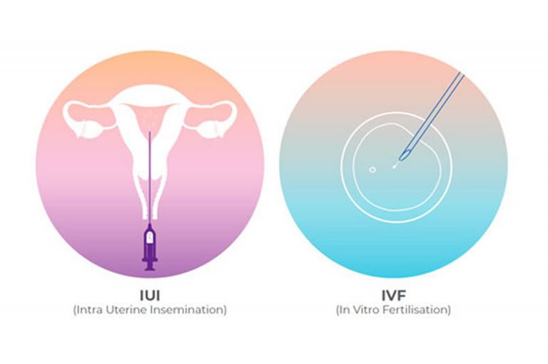 Difference Between IUI & IVF Treatment
