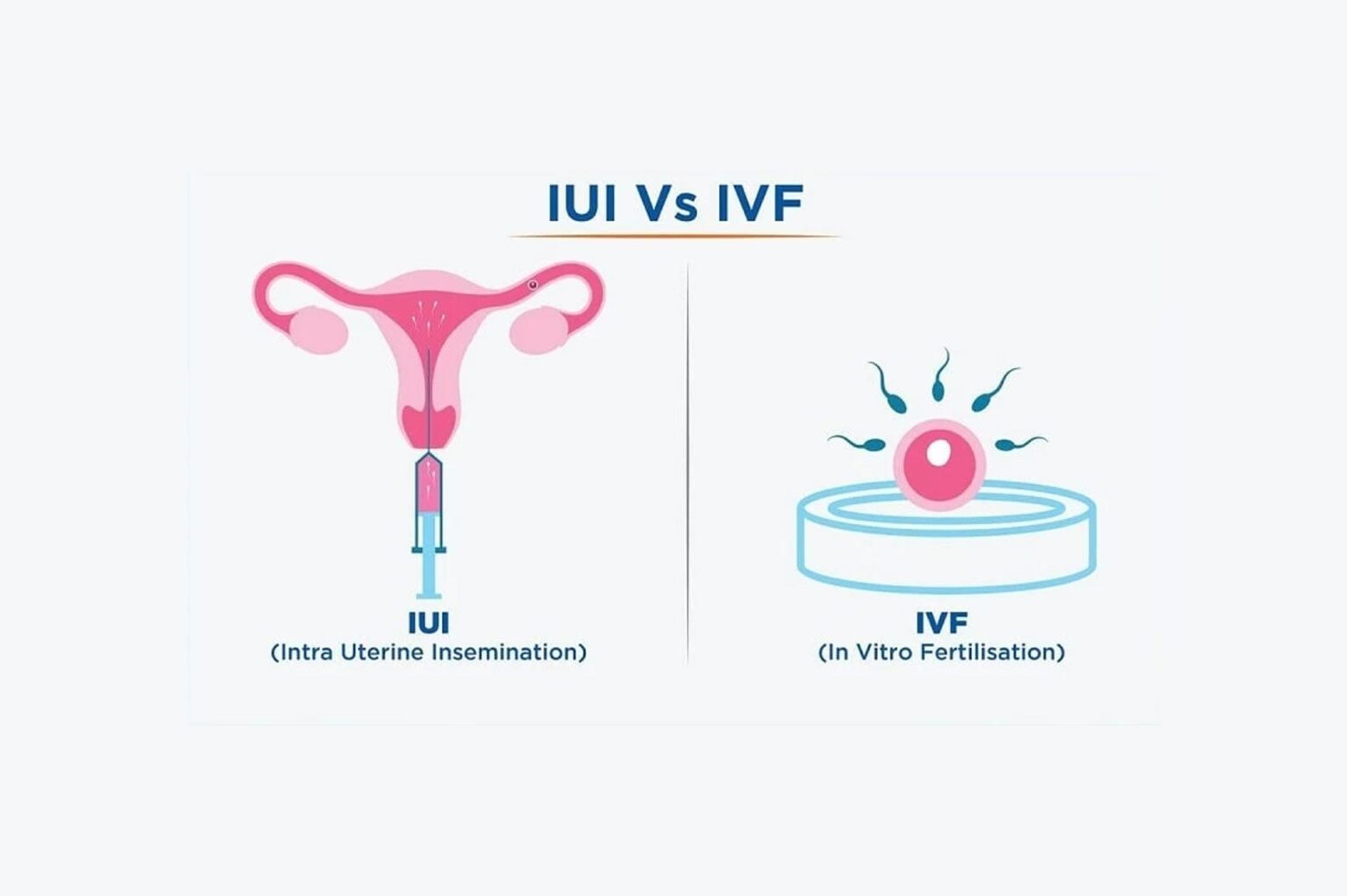 Difference Between IUI And IVF | Fertility Treatment Guide